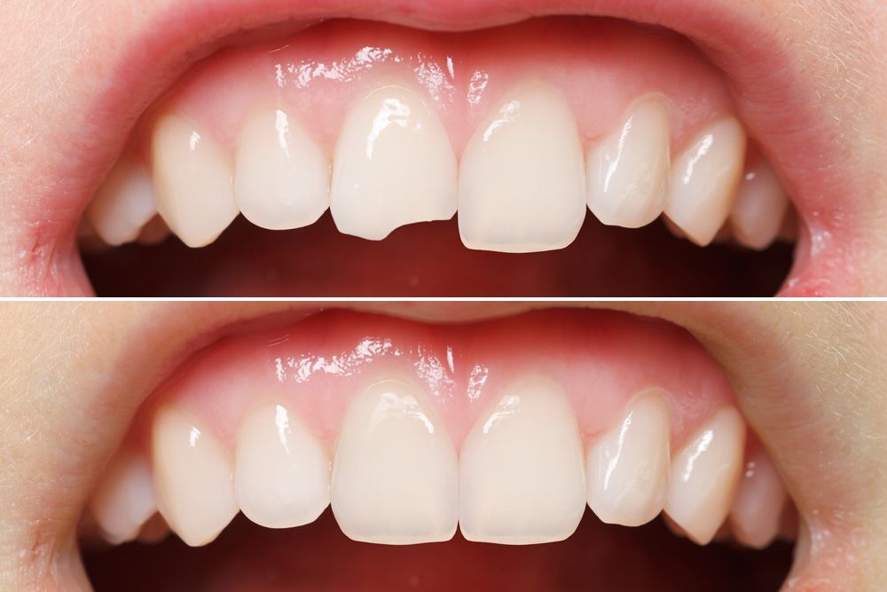 Tooth Bonding In Towson Md Drs Welinsky And Bederson