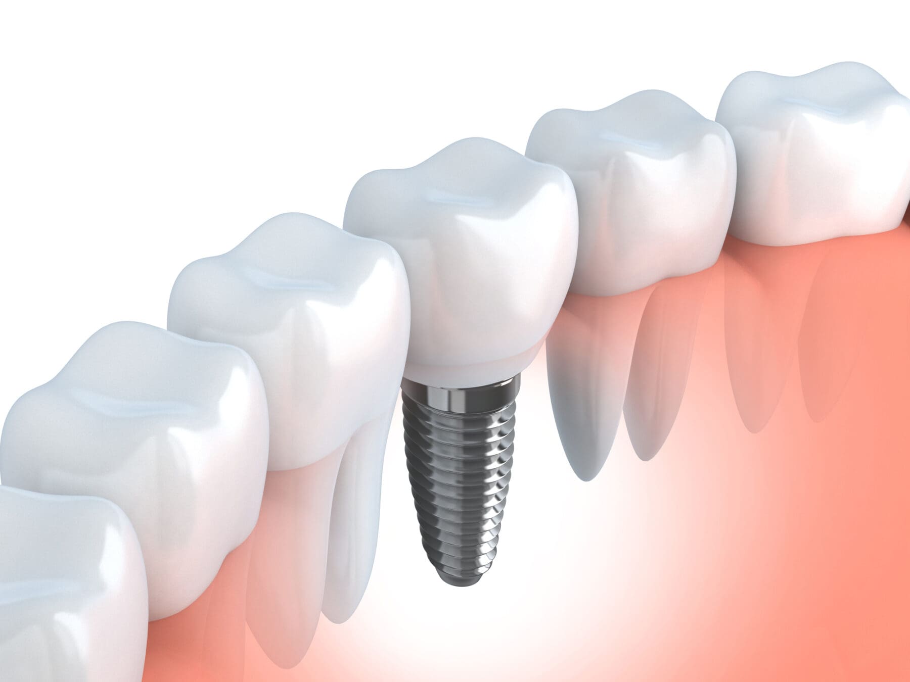 Implant-Supported Crown Towson MD | Single Dental Implant